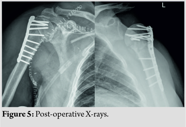 Comminuted Bilateral Simultaneous Fracture and Luxation of the Proximal ...